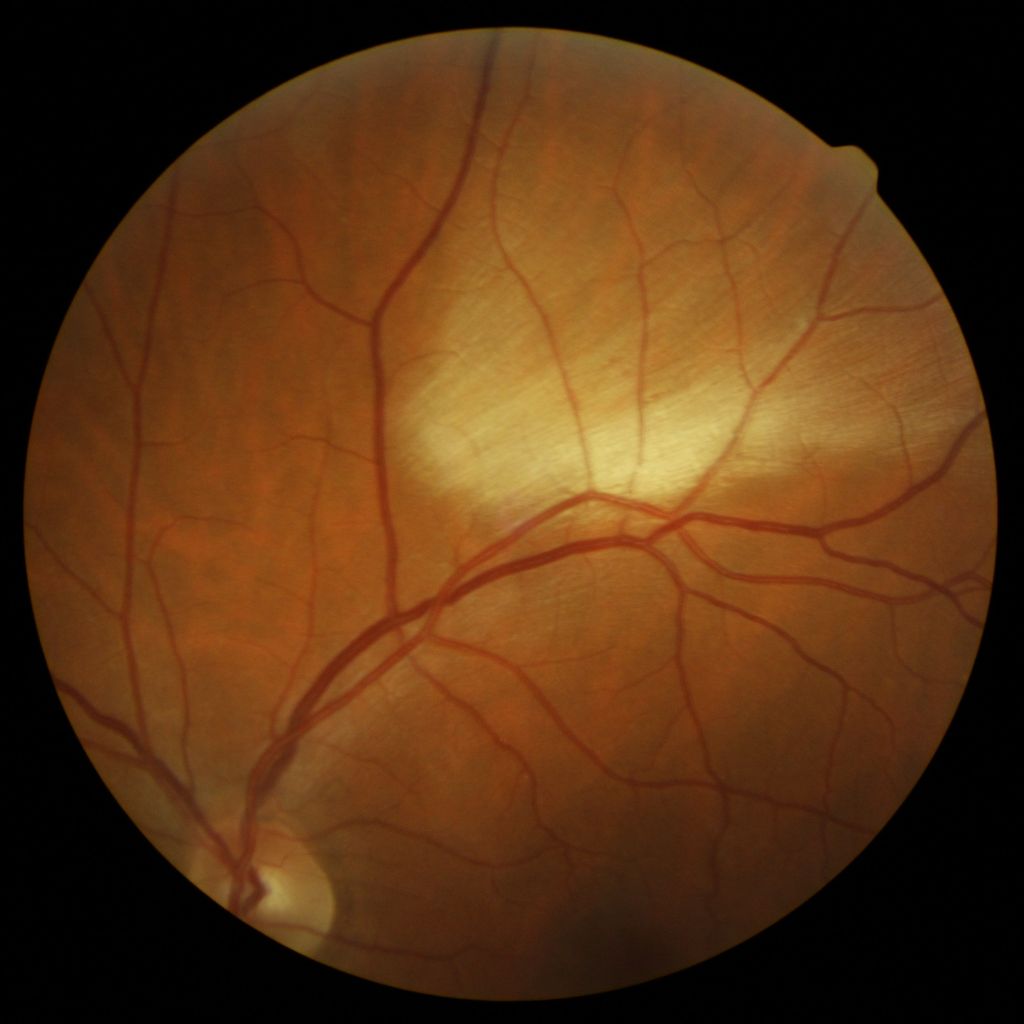 Myelinated Nerve Fiber Layer – Los Alamos Family Eyecare, P.C.