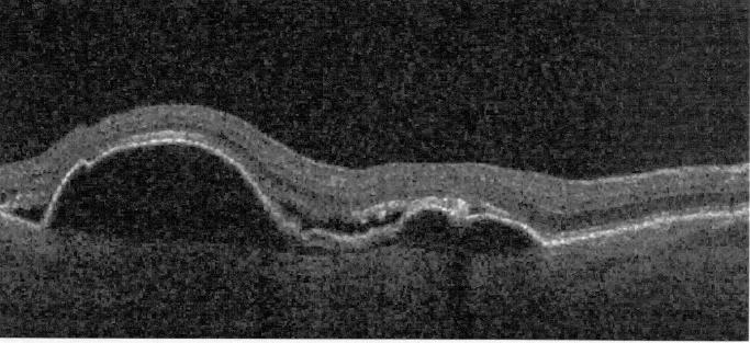 When You See Wavy Lines… – Los Alamos Family Eyecare, P.C.