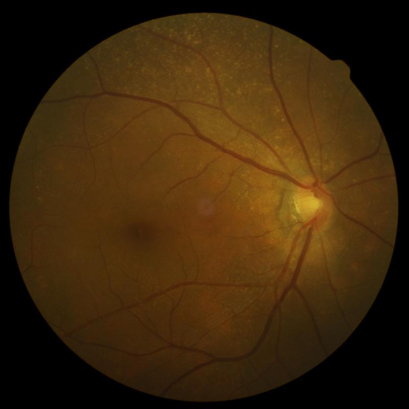 Yellow spots in the eye – Los Alamos Family Eyecare, P.C.