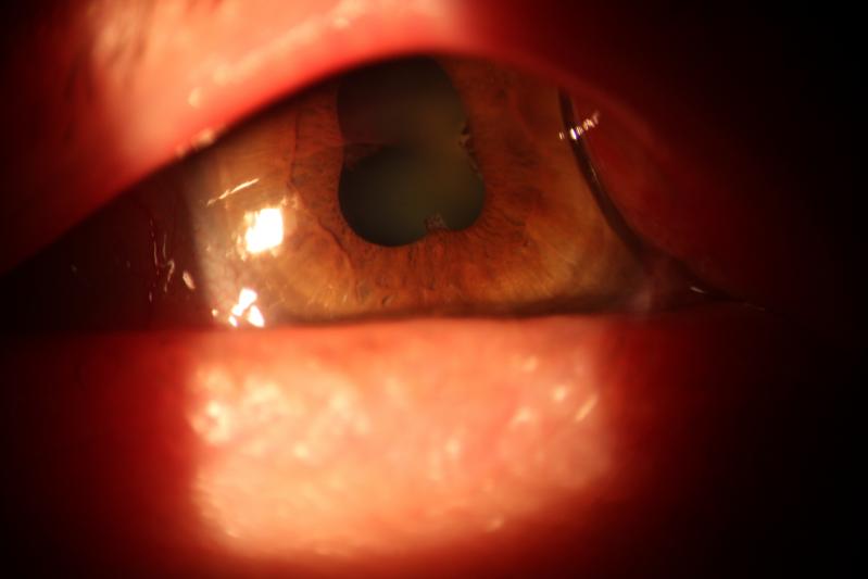 Anterior Synechiae
