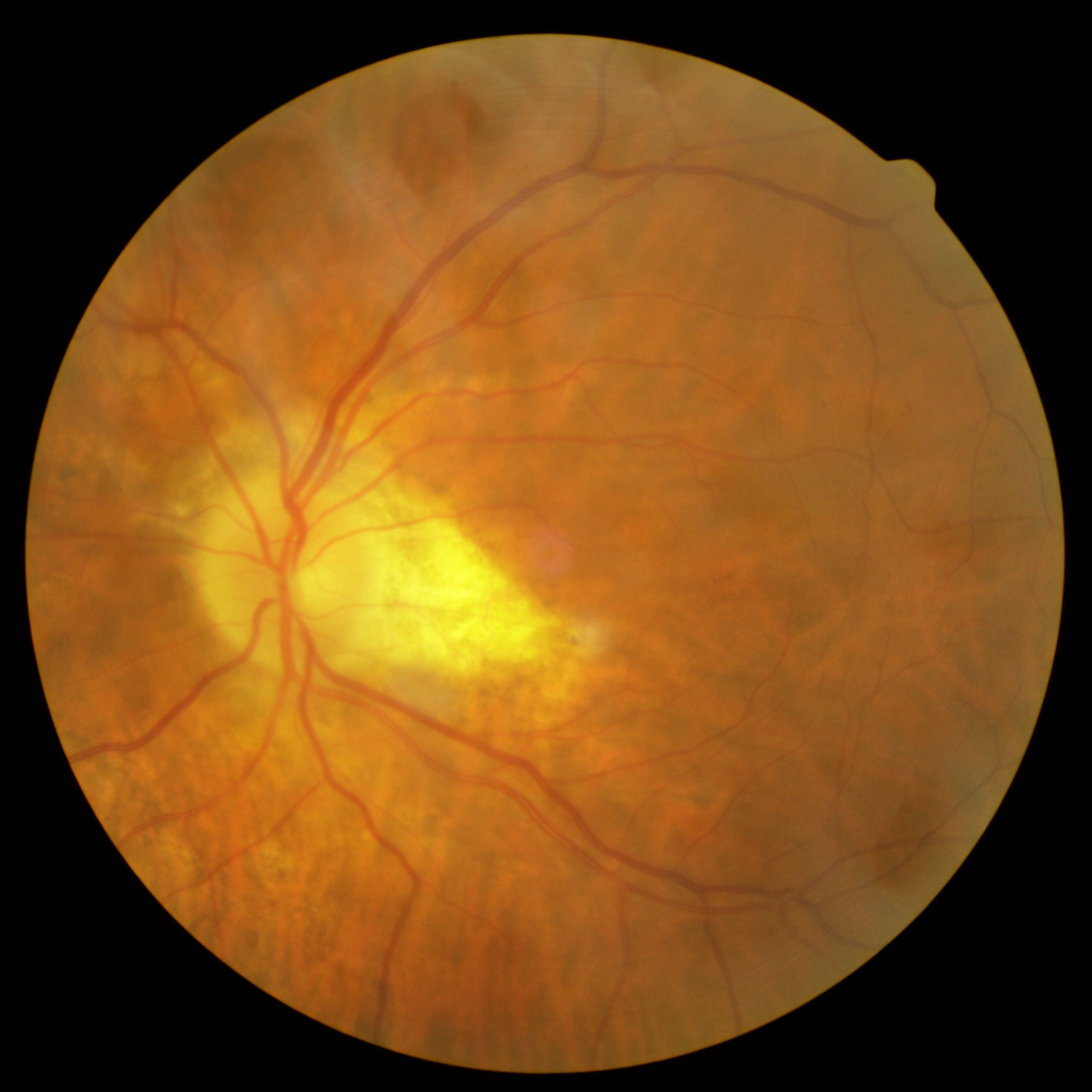 Peripapillary atrophy – Los Alamos Family Eyecare, P.C.