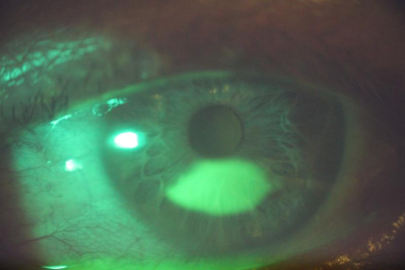 How to Treat a Scratched Cornea? – Los Alamos Family Eyecare, P.C.