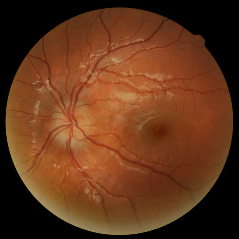 Causes of Optic Nerve Edema – Los Alamos Family Eyecare, P.C.