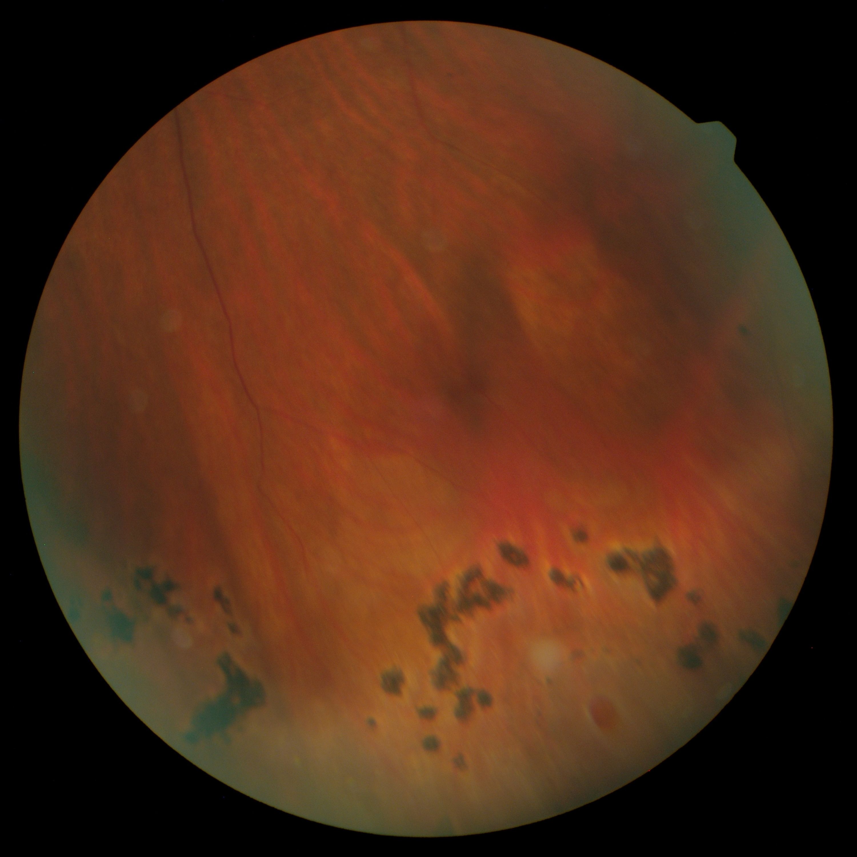 How to Treat a Retinal Hole – Los Alamos Family Eyecare, P.C.